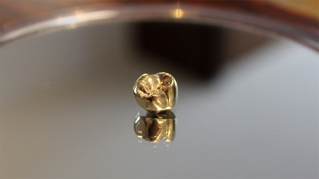 Zahnkrone – Dirk Schreyger